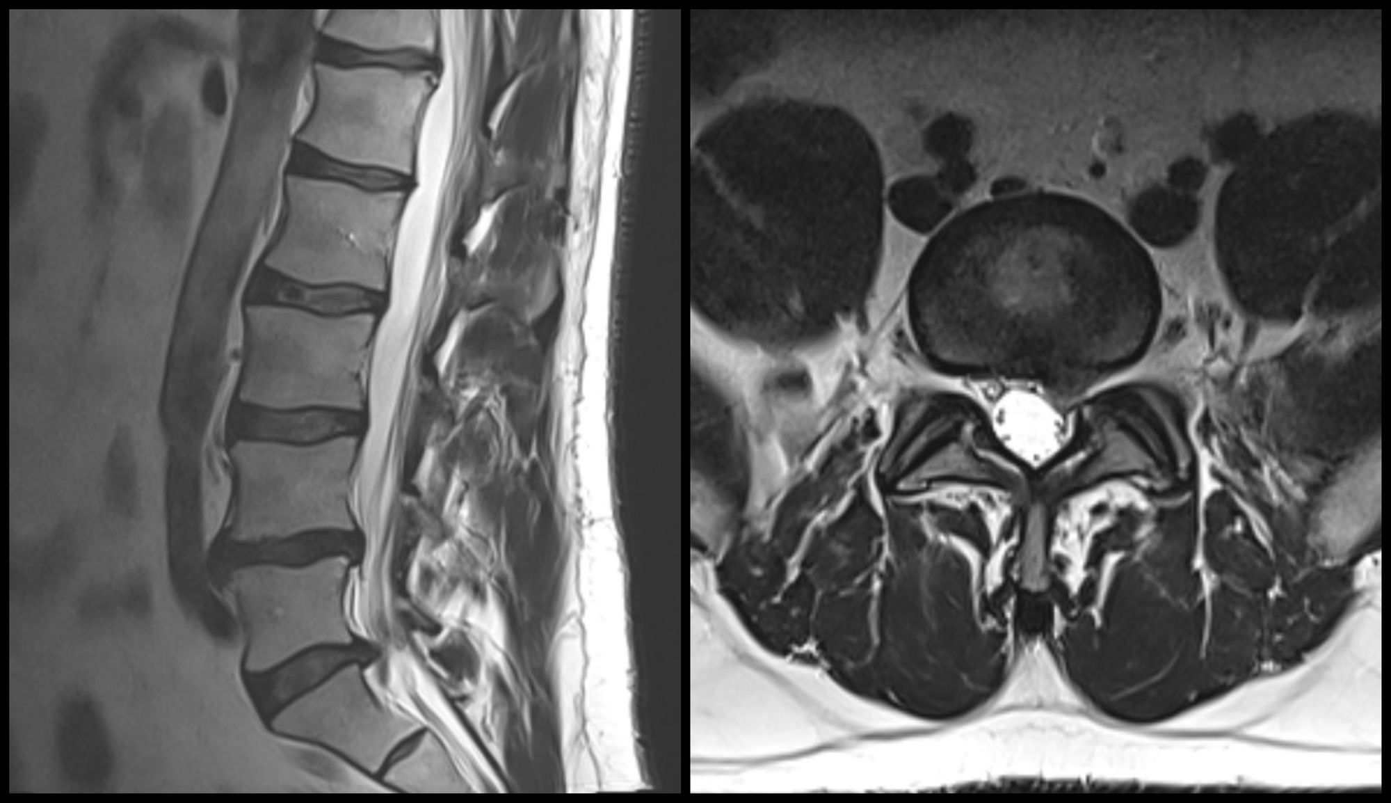 L5 S1 Microdiscectomy
