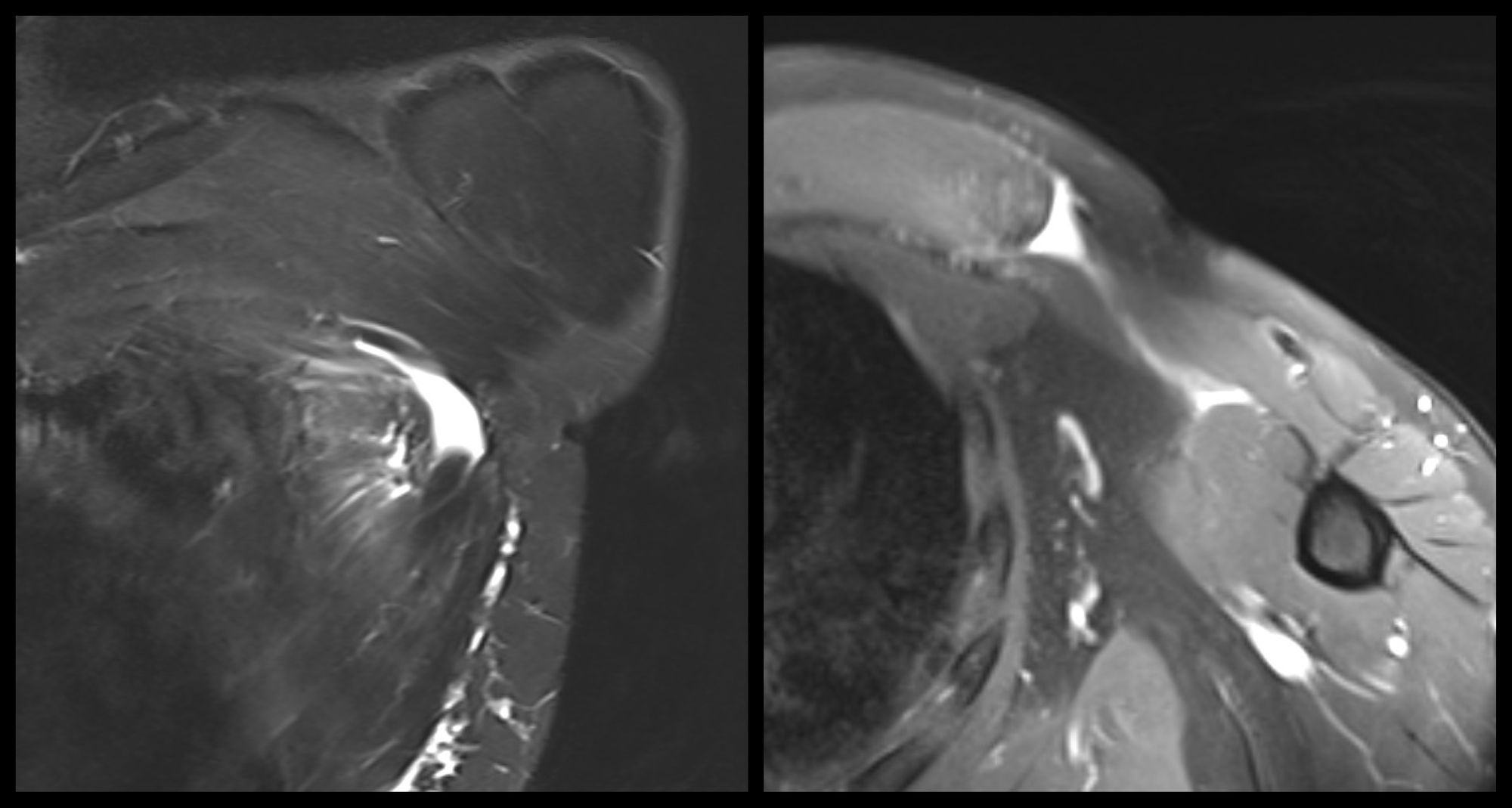 Pectoralis Major Repair