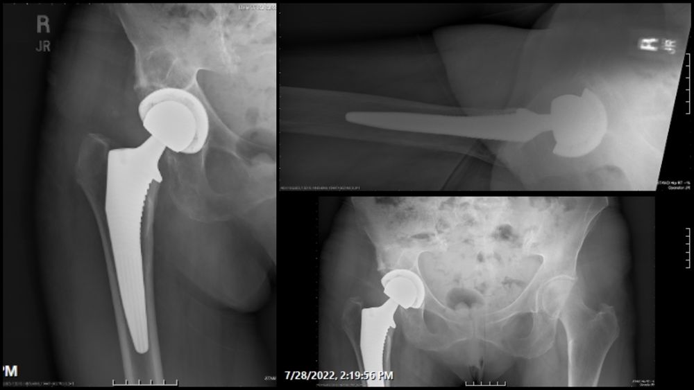 Total Hip Arthroplasty (Anterior)
