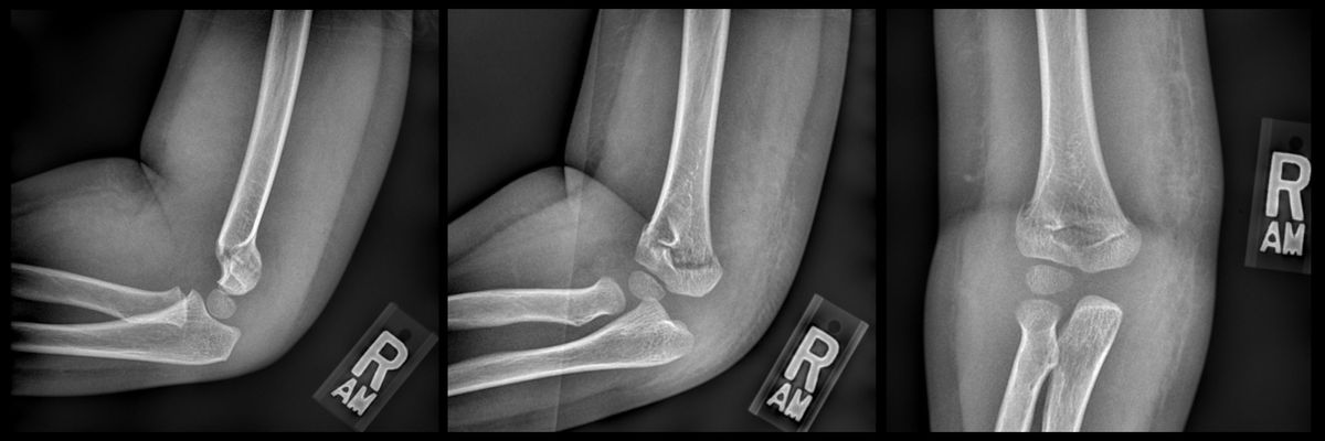 Supracondylar humerus CRPP