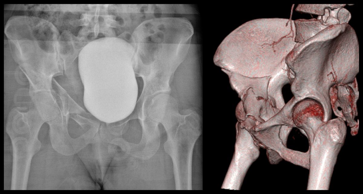 Anterior Column Acetabulum ORIF