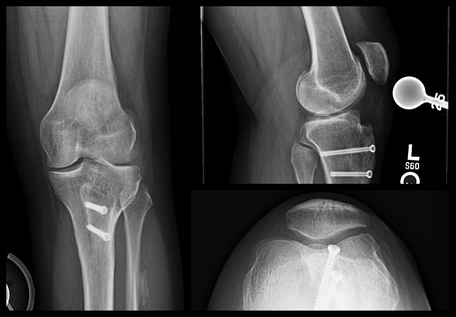 Patellofemoral Arthroplasty
